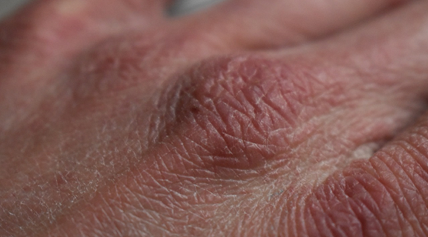 Hyaluronic Acid and Dry Skin: Debunking the Myths and Misconceptions ... Hyaluronic Acid and Dry Skin: Debunking the Myths and Misconceptions ...