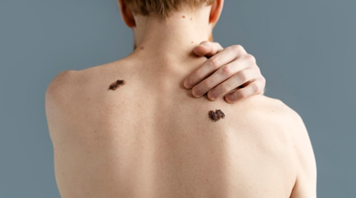 Men Skincare: Preventing and Detecting Skin Cancer – Assembled Skincare